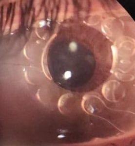 First KeraKlear surgeries performed in the Kingdom of Saudi Arabia by ...